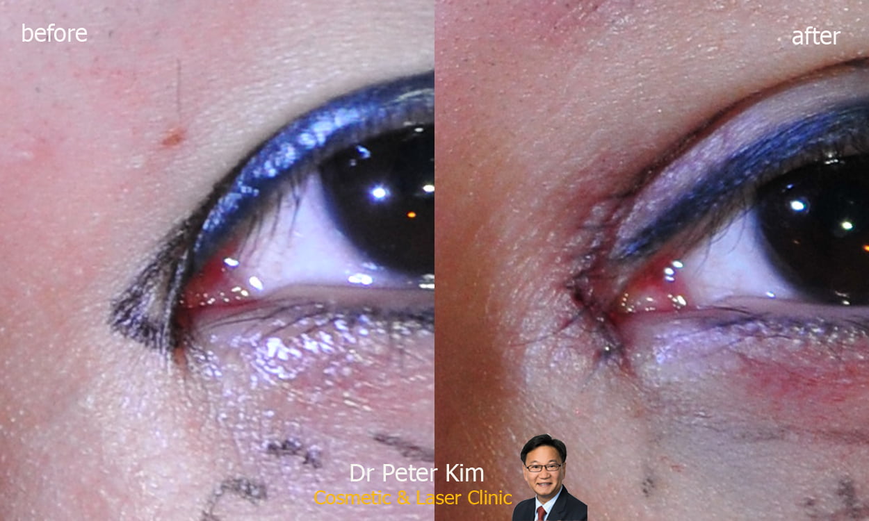 Epicanthoplasty Scar